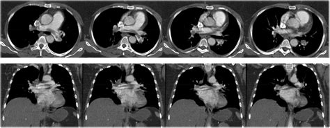 Central Pe In An Obese Patient Normal Dose Ct Protocol Was Used Axial Download Scientific