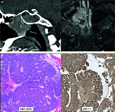 Update From The 5th Edition Of The Who Classification Of Nasal