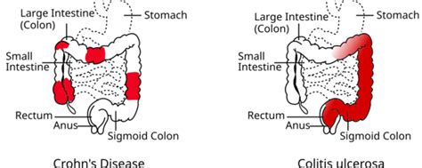 Understanding Ulcerative Colitis Symptoms Causes Treatments
