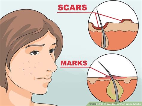 2 Easy Ways To Get Rid Of Red Acne Marks With Pictures