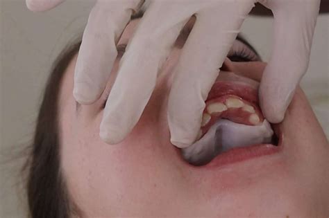 The Groundbreaking Invisalign Palatal Expander A Tool That Is Transforming Maxillary Expansion