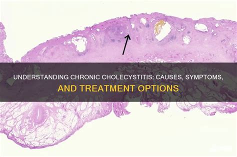 Understanding Chronic Cholecystitis Causes Symptoms And Treatment