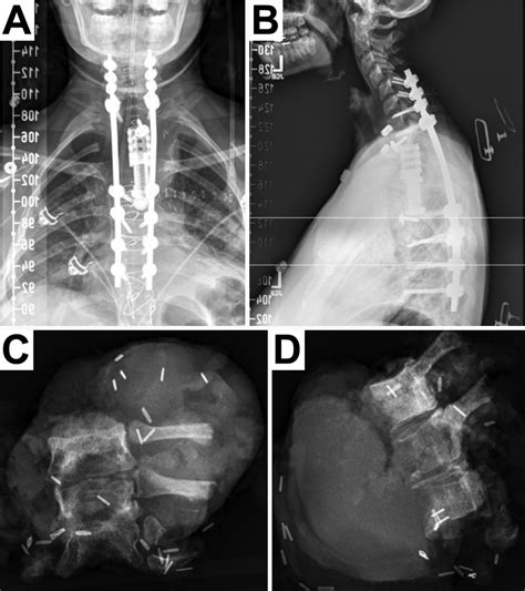 Clamshell Thoracotomy