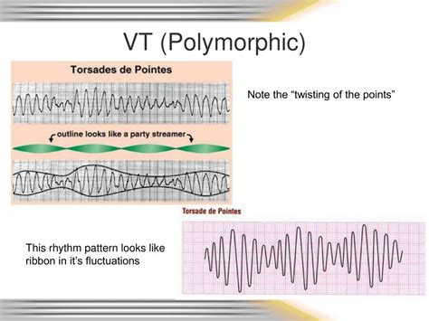 Ppt Rhythm And 12 Lead Ekg Review Powerpoint Presentation Free Download Id 6720077