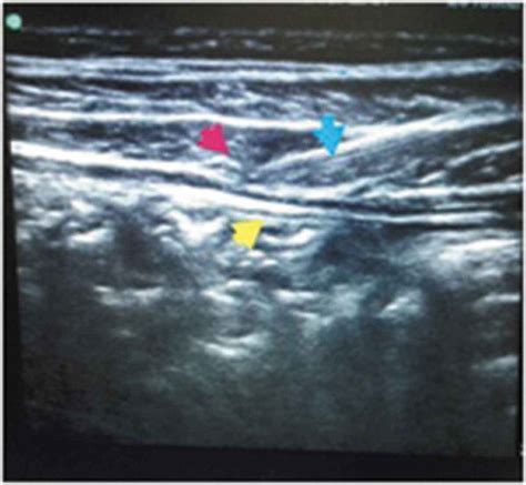 Ilioinguinal Nerve Block Ultrasound