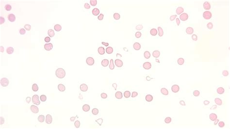 Aplastic Anemia Aa Definition Causes Symptoms And Diagnosis