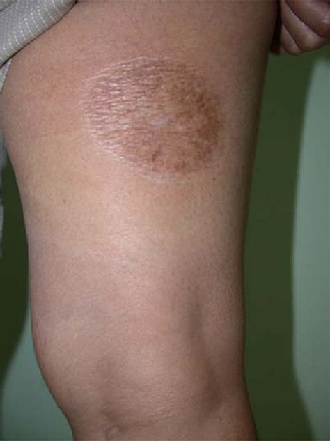 [pdf] Generalized Morphea A Case Report Semantic Scholar