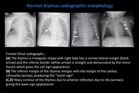 Types Of Normal Neonatal Thymic Shadow Dr Ahmed Tawfik