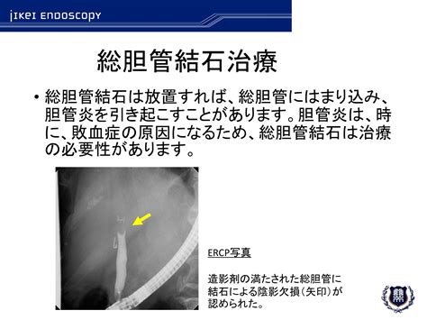 胆膵疾患癌の早期発見と内視鏡診断・治療