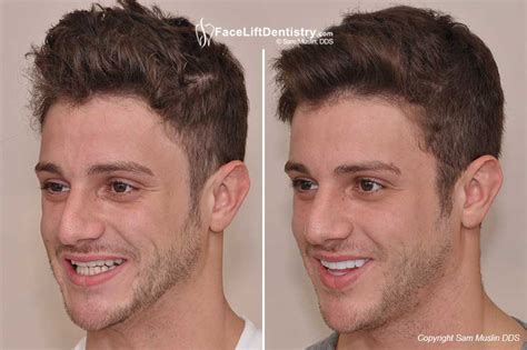 Overbite Treatment Options And Benefits Explained