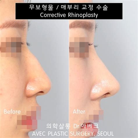 매부리코 And 휜코 수술 무보형물 코수술 후기 【dr 아베크 코성형】 네이버 블로그