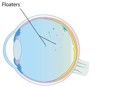 Retinal Detachment Vision