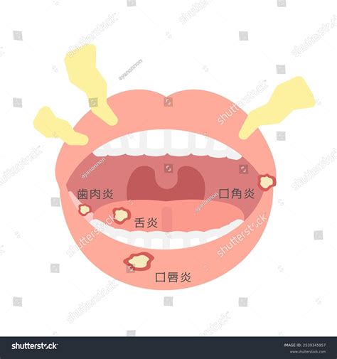 Stomatitis Types Illustration Translation Glossitis Angular Stock