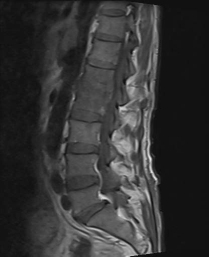 Radiopaedia Case Spondylodiscitis Id 158072 Study 129766 Nc Commons
