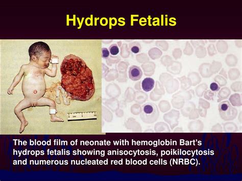 Ppt Thalassemia And Hemoglobinopathies Powerpoint Presentation Free
