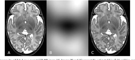 Figure 1 From A Review On Automatic Fetal And Neonatal Brain Mri Segmentation Semantic Scholar
