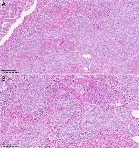Analysis Of Surgical Treatment Of Appendix Neuroendocrine Neoplasms—17 Years Of Single Center