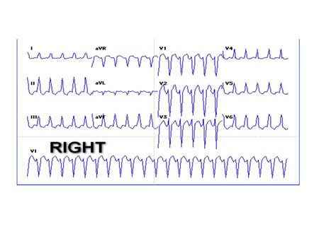 Localization Of Wpw Accessory Pathway By Surface Ecg Pptx Heart And Cardiovascular