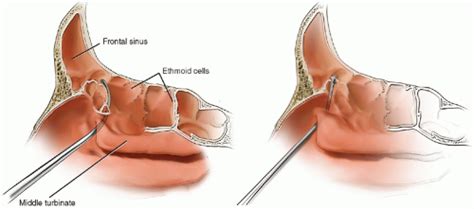 Endoscopic Frontal Sinusotomy Draf 2a Procedure Ento Key