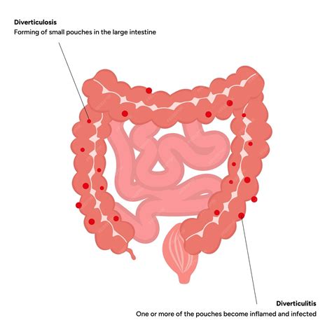 La Colitis Ulcerosa Es Una De Las Causas Más Comunes De La Enfermedad