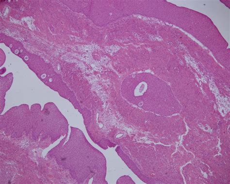 Hex Intracystic Papillary Configuration Composed Of Transitional Type