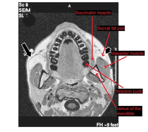 Buccinator Muscle Mri