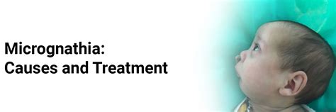 How Common Is Micrognathia