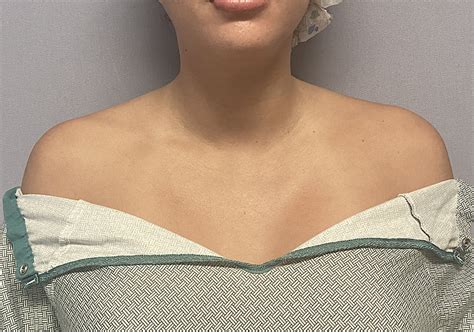 Plastic Surgery Case Study Clavicle Bone Alignment And Apposition In