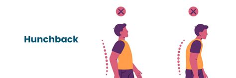 Understanding Hunchback Kyphosis Types And Symptoms