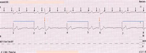 Syncope And Block