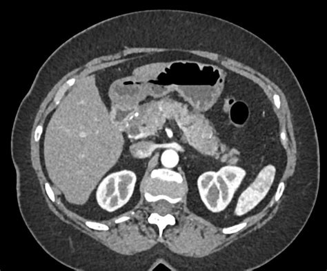 Acute Pancreatitis Simulates Mass Pancreas Radiology Case Studies