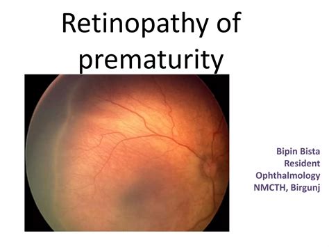 Retinopathy Of Prematurity Pptx