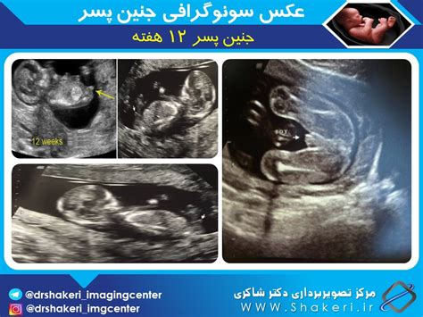 عکس سونوگرافی جنین پسر مرکز تصویربرداری دکتر شاکری