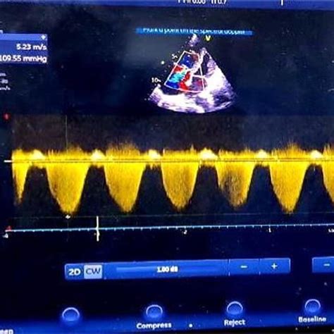 Echocardiography Imaging Showing Measurement Of Right Ventricular