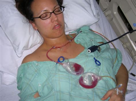 Drainage After Thyroidectomy Best Drain Photos Primagemorg