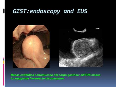 Ppt Gistdiagnosi Endoscopica Powerpoint Presentation Free Download Id224094