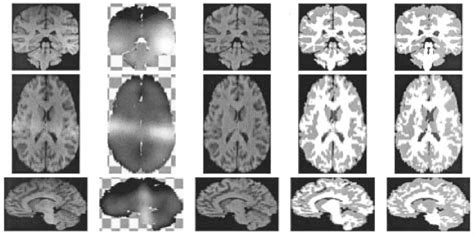 Figure 10 From Segmentation Of Brain Mr Images Through A Hidden Markov