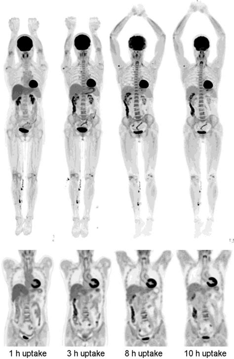 Delayed Imaging For Subject 2 256 Mbq Injected 14 Min Scan Duration