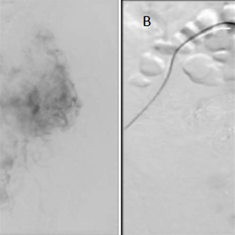 Embolization Of The Left Pelvic Tumor Artery A Before Tumor Artery
