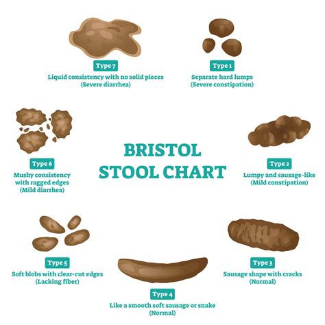 Gallbladder Stones In Stool