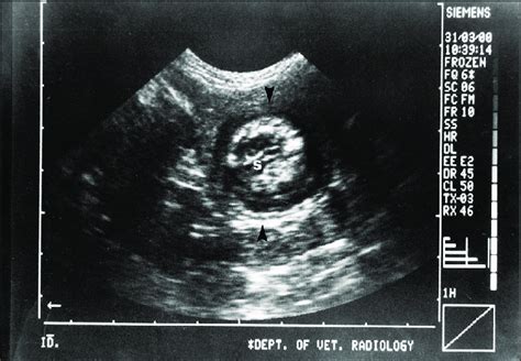 Transverse Ultrasonographic Section Of An Ileocolic Intussusception Download Scientific Diagram