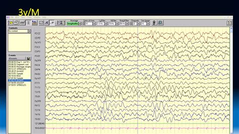 Normal Eeg Waveforms Pptx