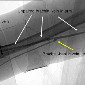 Schematic Illustrations Of The Anatomic Classification And Distribution