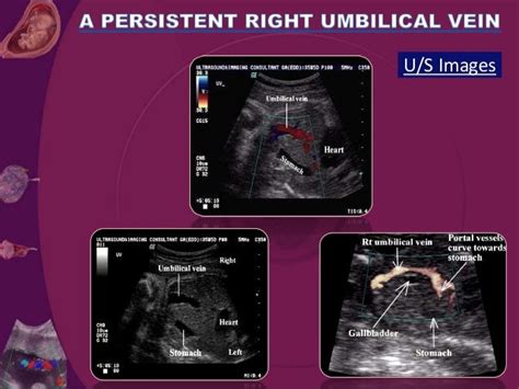 Umblical Cord Presentation