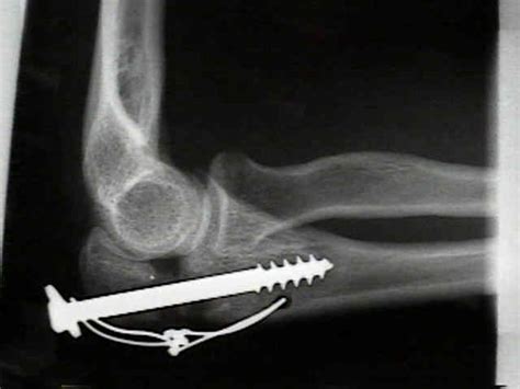 Left Olecranon Fracture Mumugogreen