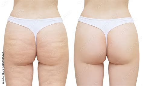 Cellulite On The Buttocks And Thighs White Isolate Before And After