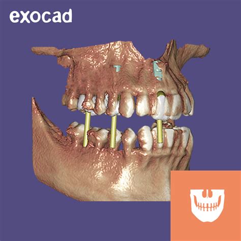 Exocad Dicom Viewer Metrodent