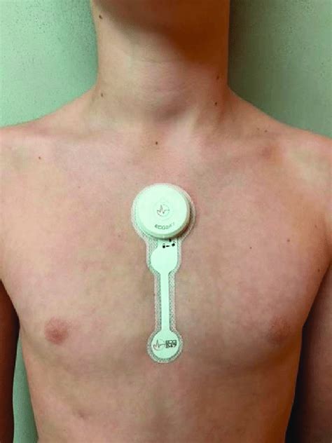 E Ecg247 Smart Heart Sensor Attached To The Patients Chest Download Scientific Diagram