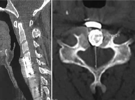Postoperative Ct Cervical Spine Anteroposterior And Lateral Views