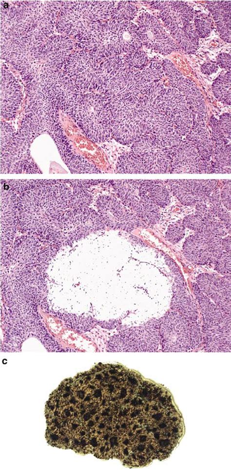 Exophytic Papilloma Of Bladder